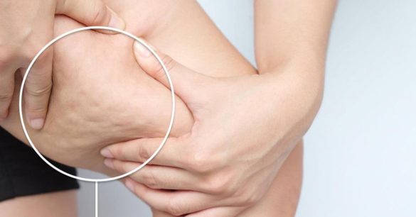 Understanding Cellulite & Breaking Beauty Standards for Women